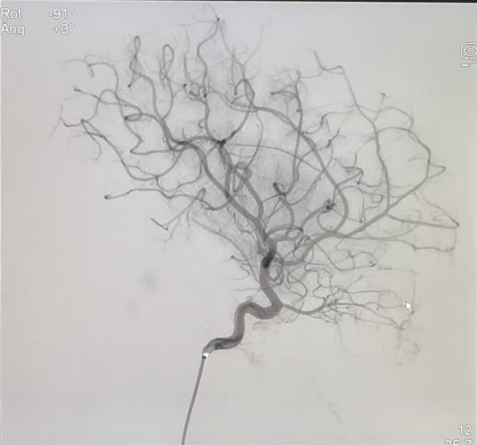 Quimioterapia Intraarterial, Procedimiento de Vanguardia – Hospital ...